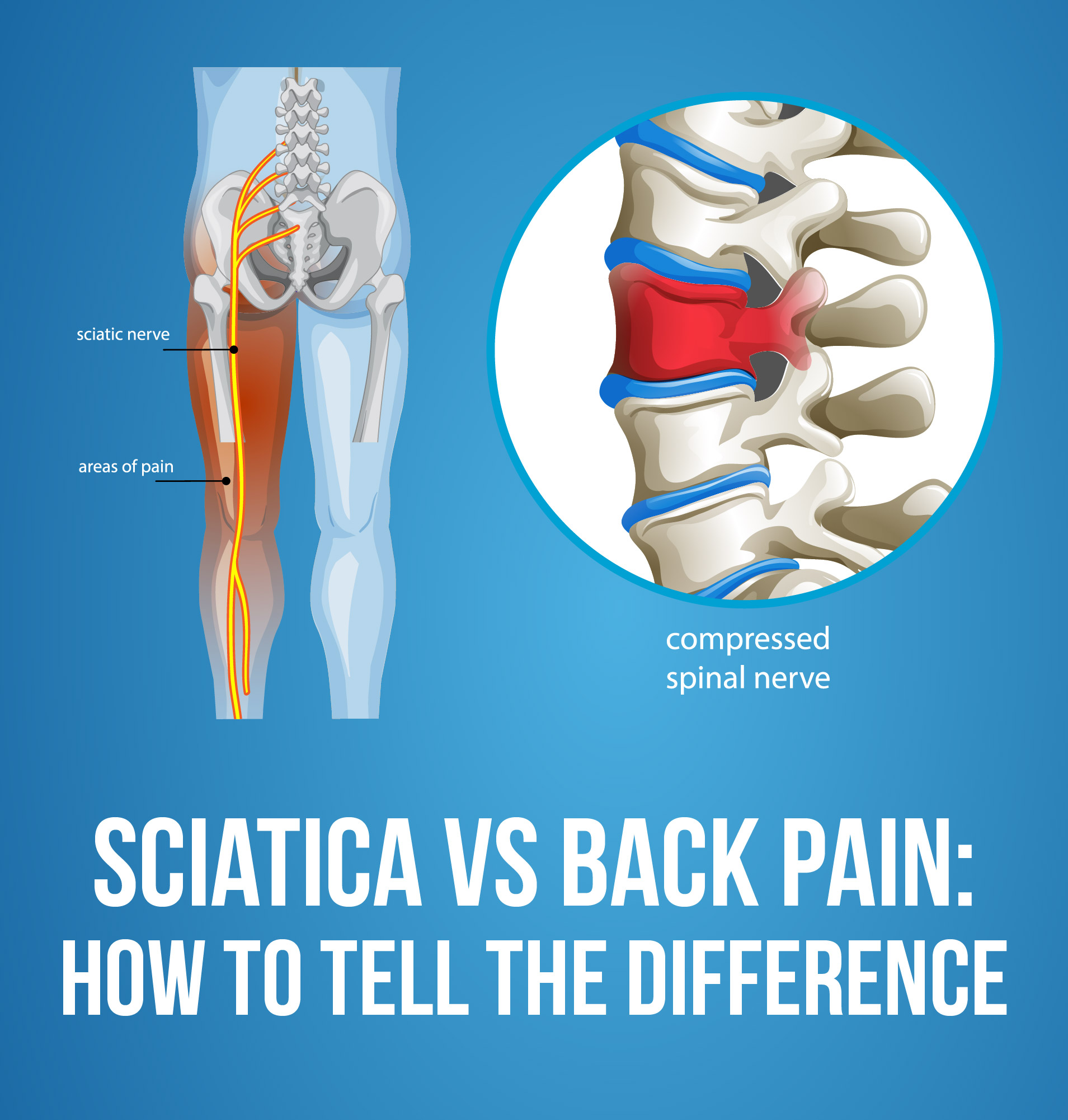 Sciatica vs Back Pain – Symptoms, Causes & Key Differences