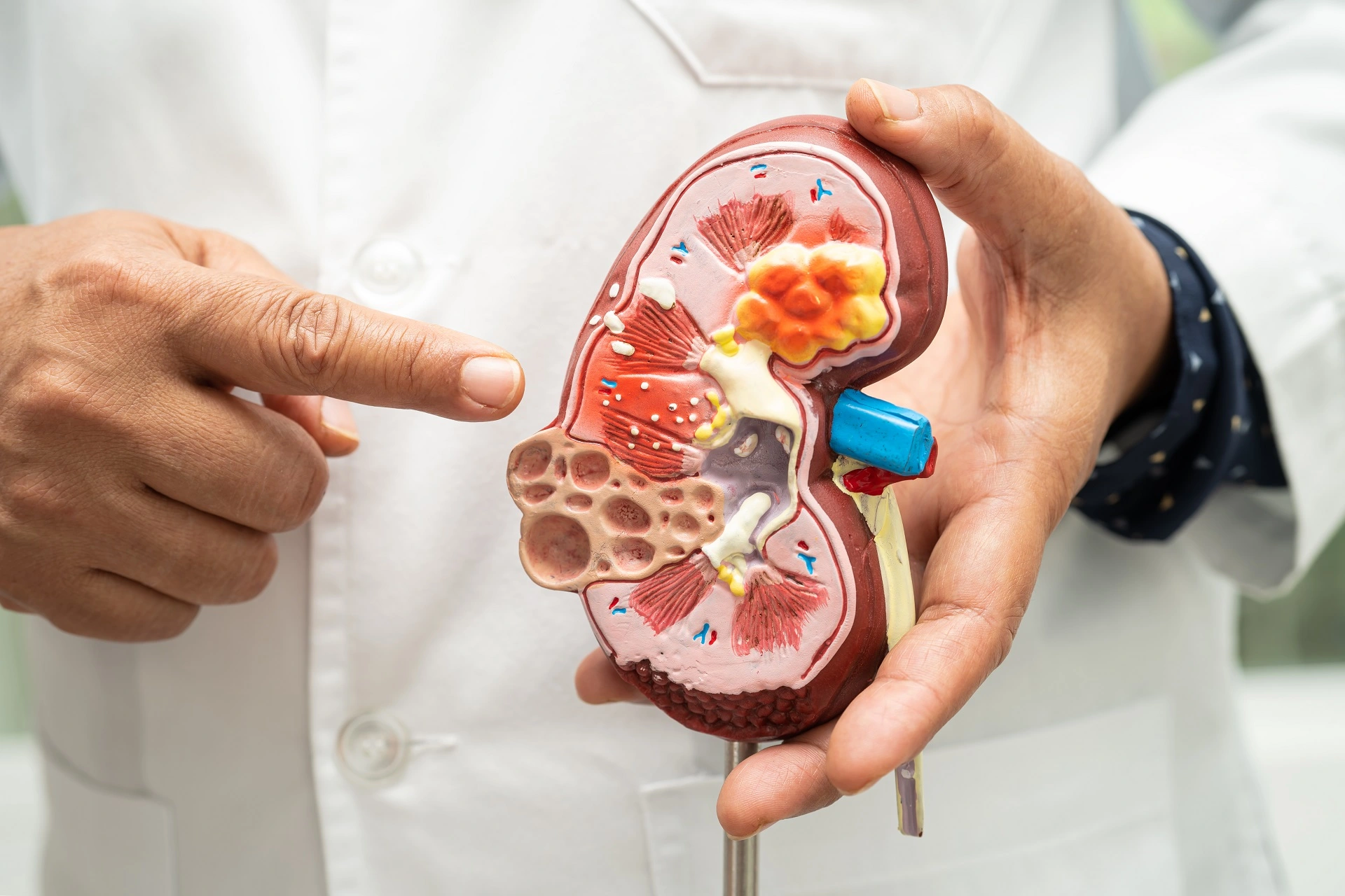 Best Nephrologist In Hyderabad | Kidney Specialist in Hyderabad | STAR Hospitals